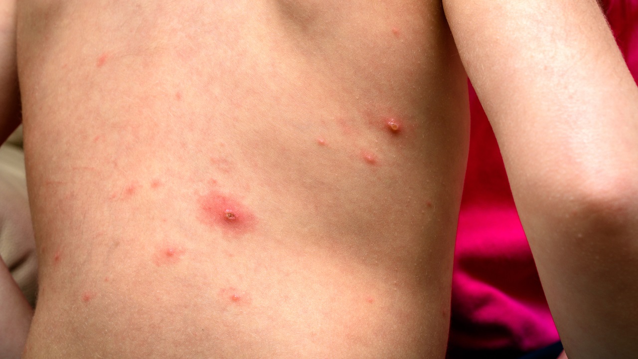 Mumps And Measles Outbreaks Keep Health Officials Busy